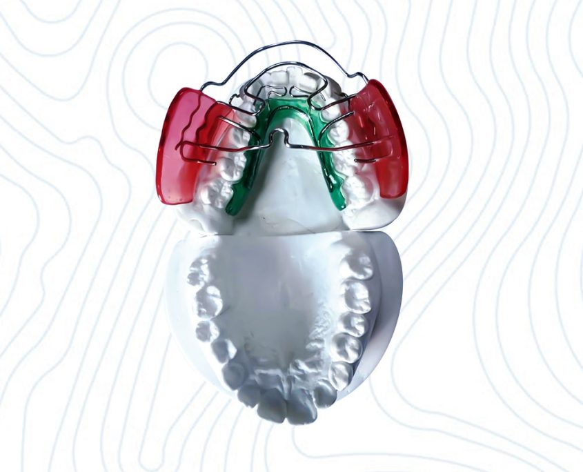 Frankel Appliance – China Orthodontic