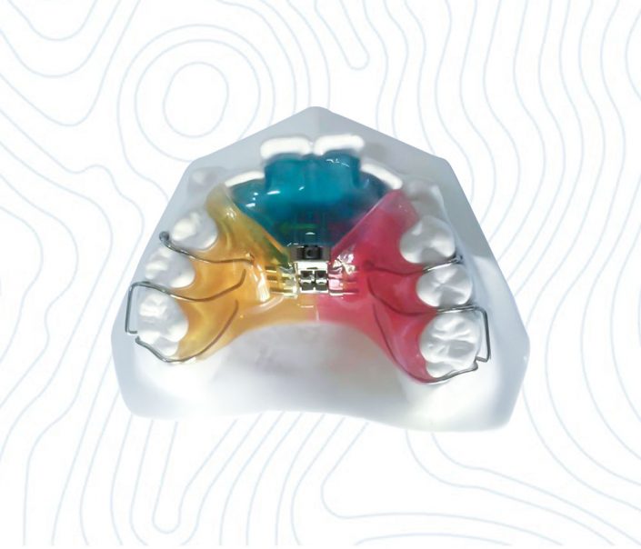 quad-helix-1 | China Orthodontic