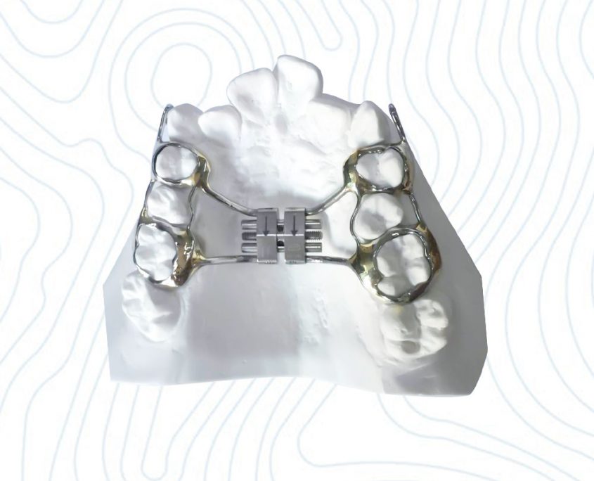 Standard Rapid Palatal Expander – China Orthodontic