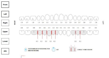 clear-aligner-IPR | China Orthodontic