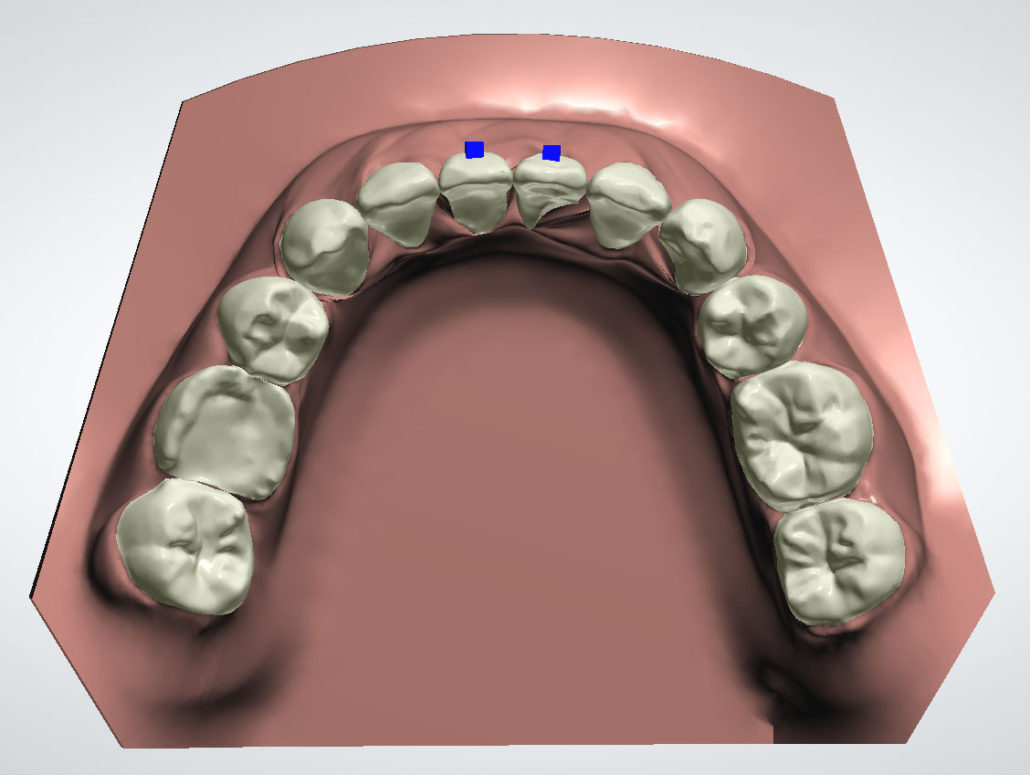 How we make Clear Aligner works? – China Orthodontic