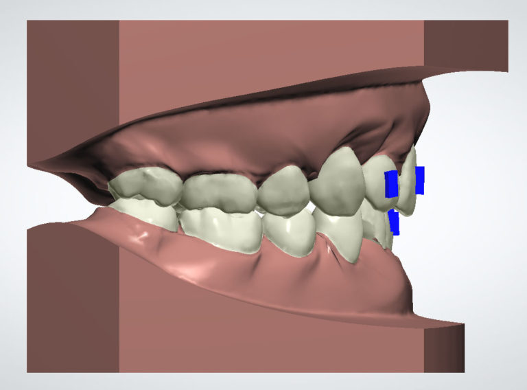 How we make Clear Aligner works? – China Orthodontic
