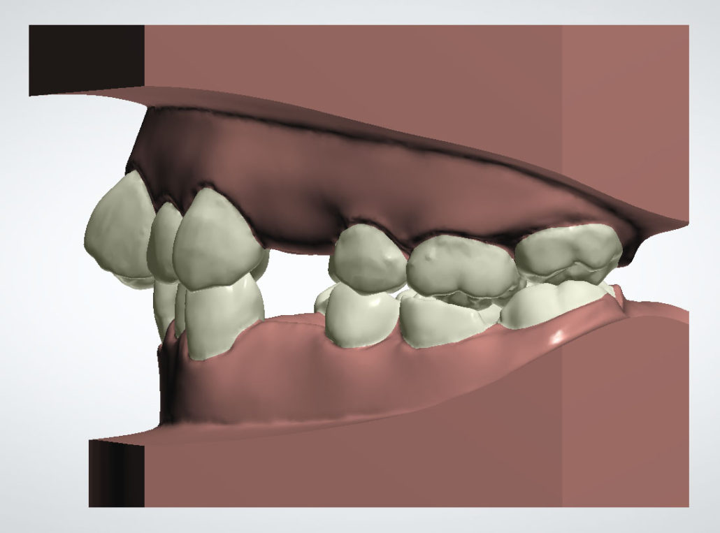How we make Clear Aligner works? – China Orthodontic
