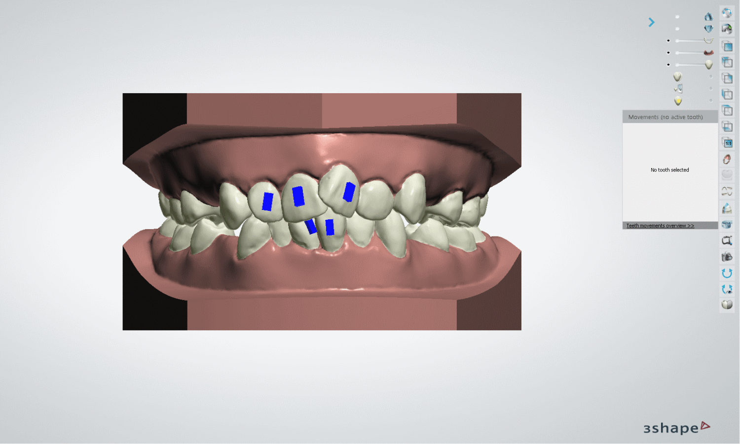 How we make Clear Aligner works? – China Orthodontic