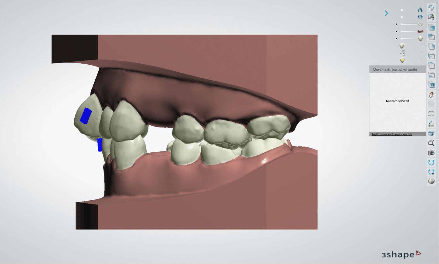 How we make Clear Aligner works? – China Orthodontic
