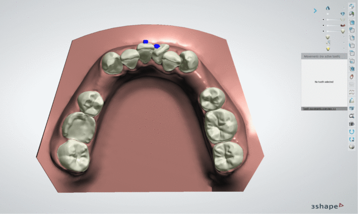 How we make Clear Aligner works? – China Orthodontic