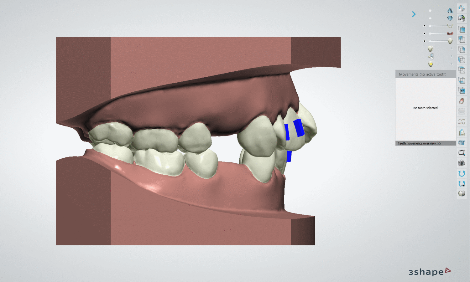 How we make Clear Aligner works? – China Orthodontic